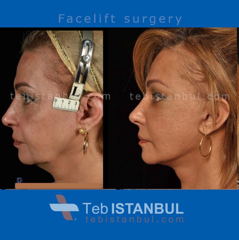 Facelift in der Türkei ️ Istanbul 2023 Beste Preise - Behandlungen in ...
